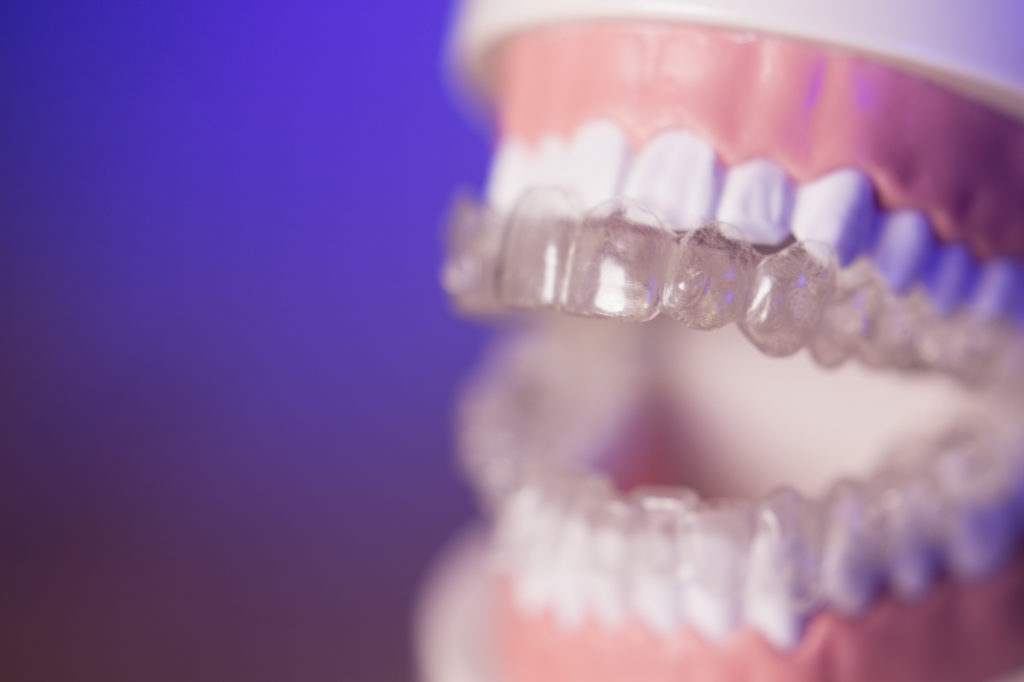 Dr. Hanna Transforms Smiles With Invisalign® | The CDG of Houston